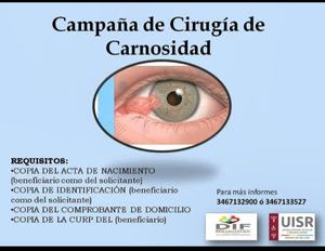 Campaña de Cirugía de Carnosidad – Ayuntamiento de Nochistlán